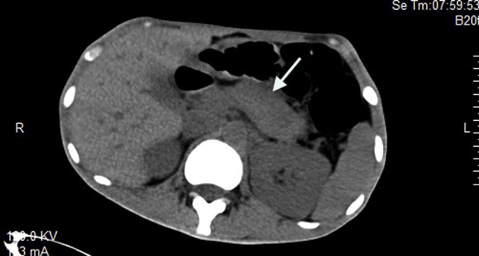 Acute pancreatitis as initial manifestation in an adult patient with ...