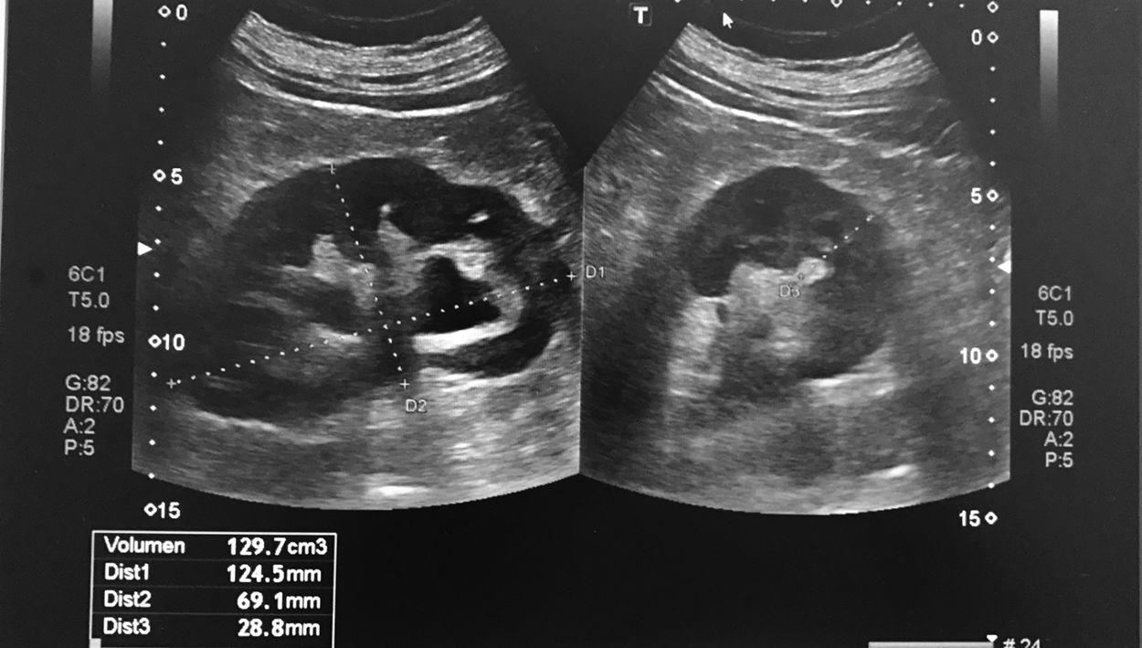 Utilidad y fiabilidad de la ecografía clínica abdominal en medicina ...