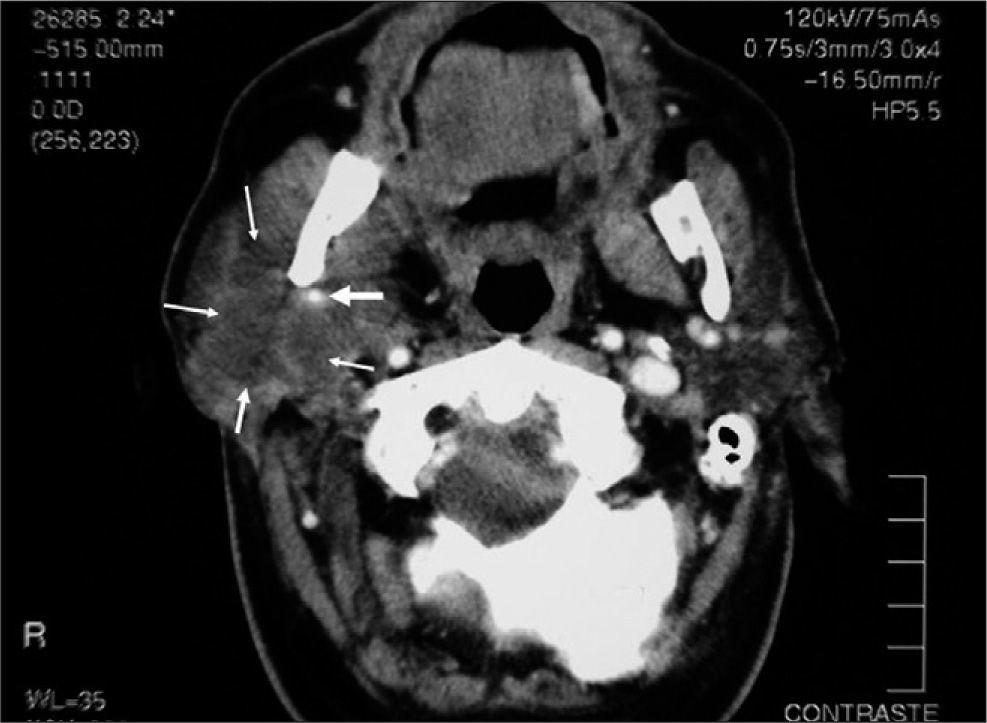 Absceso parotídeo bacteriano | Enfermedades Infecciosas y Microbiología ...
