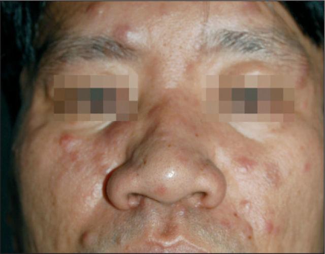 Empeoramiento de lesiones de lepra en un paciente filipino ...