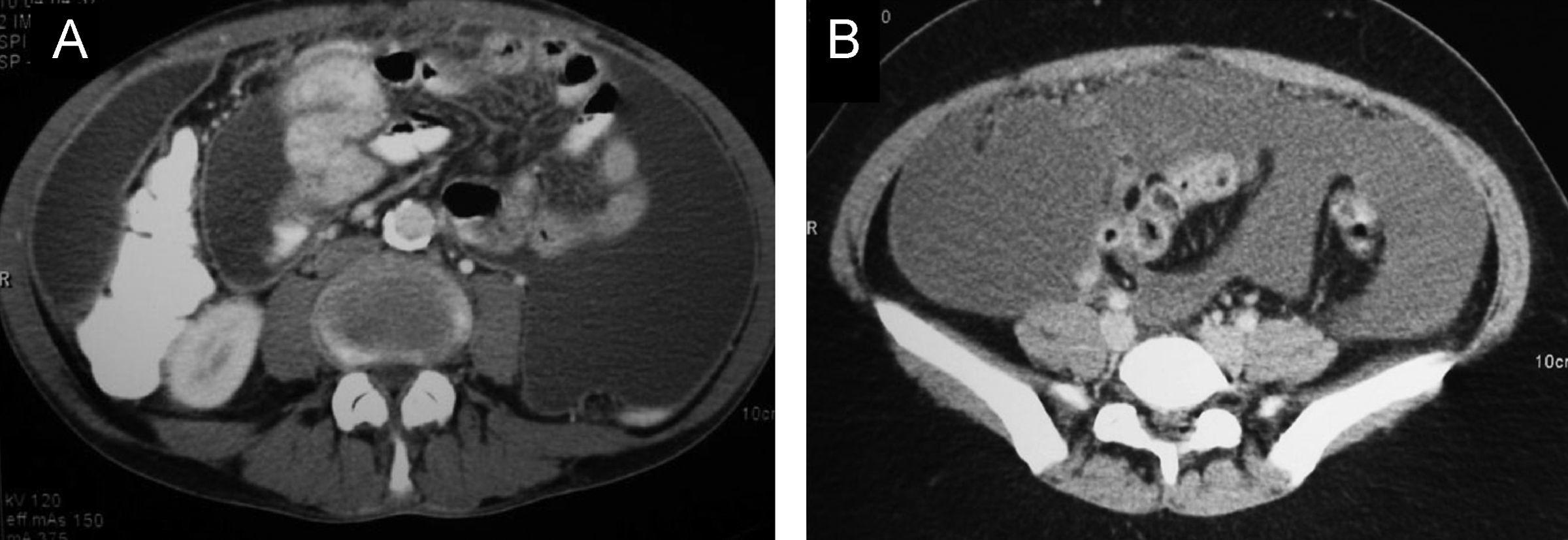 Peritonitis tuberculosa: revisión de 16 años en un hospital general ...