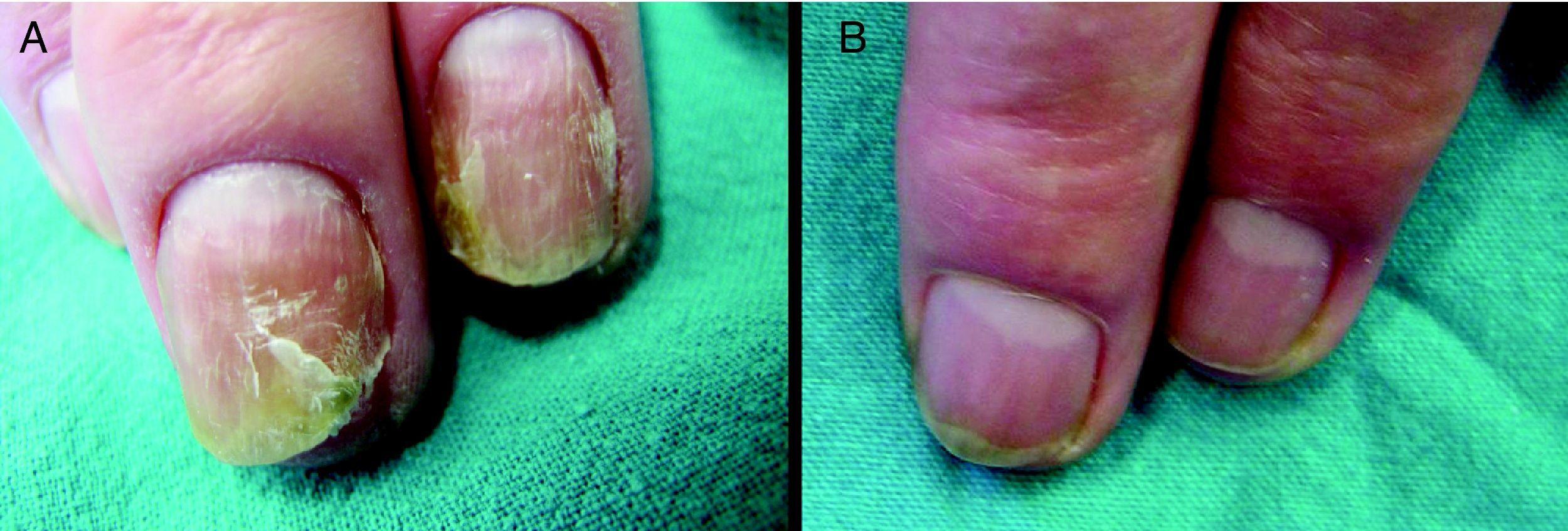 Onicólisis distal en un paciente anciano polimedicado resuelta con ...