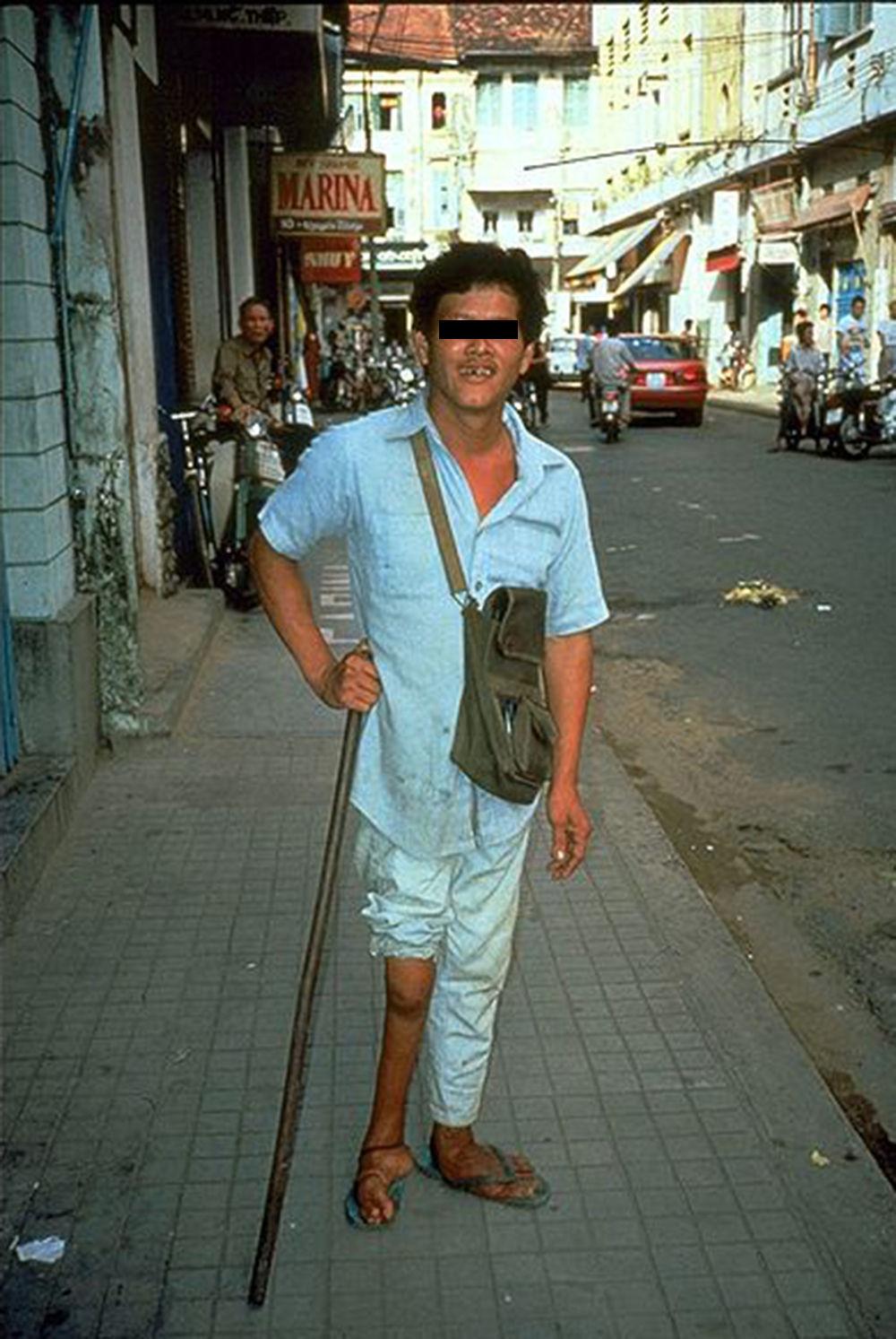 La polio, el largo camino hacia el final de la partida | Enfermedades ...