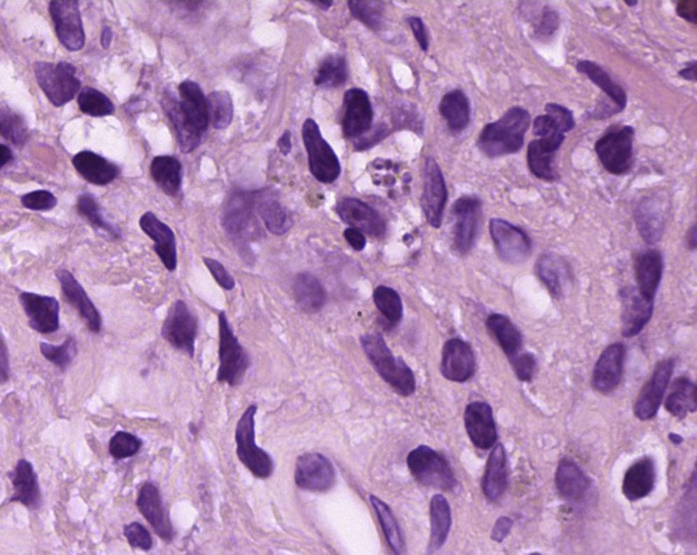 Masa pulmonar en paciente con infección por el virus de la ...