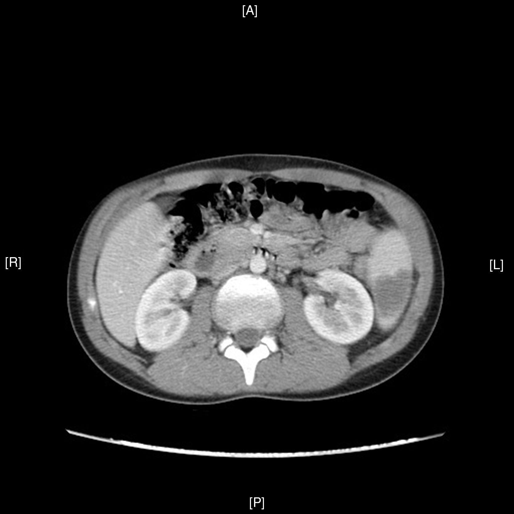 Infarto esplénico debido a una infección común | Enfermedades ...