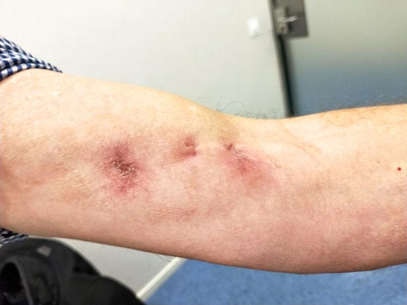 Múltiples abscesos arrosariados en el brazo en un paciente ...