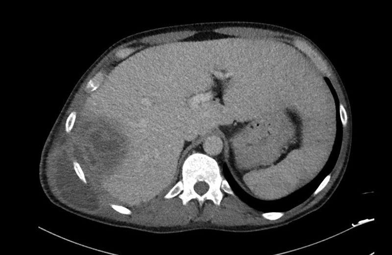 Absceso de pared torácica | Enfermedades Infecciosas y Microbiología ...