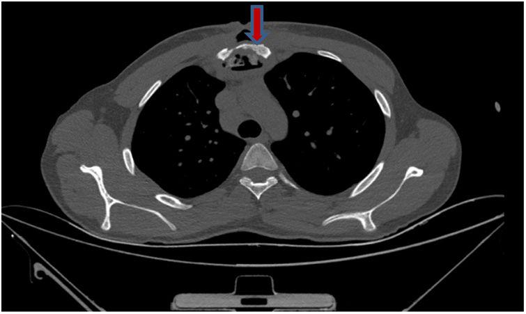 A mass over manubrium sterni causing lytic bone lesions | Enfermedades ...