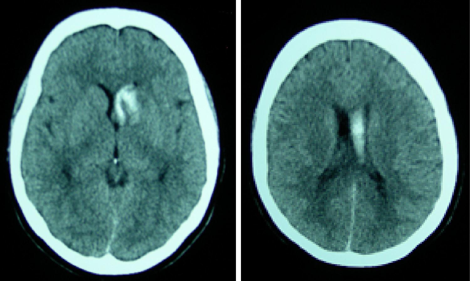 Hemorragia de núcleo caudado por anestesia dental | Neurología