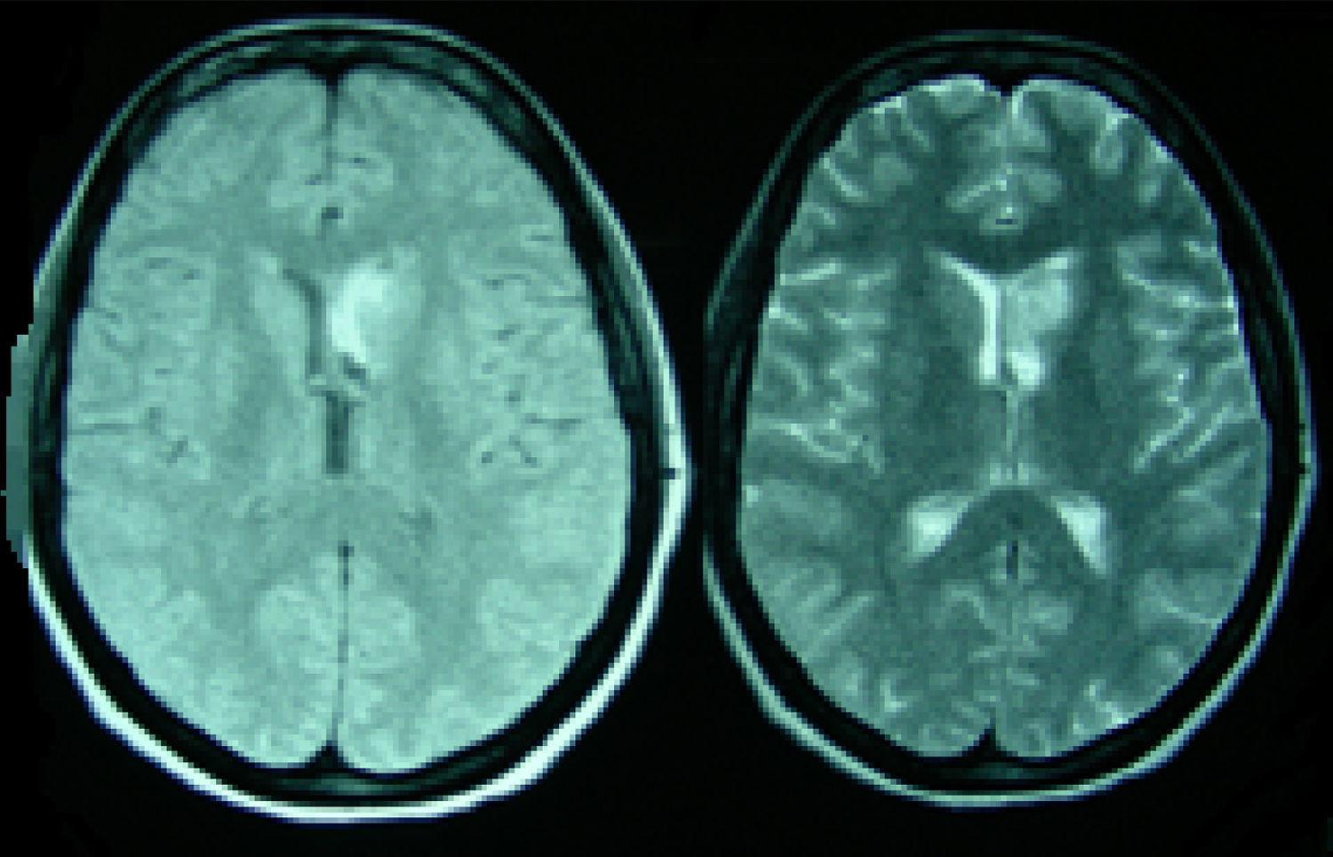 Hemorragia de núcleo caudado por anestesia dental | Neurología
