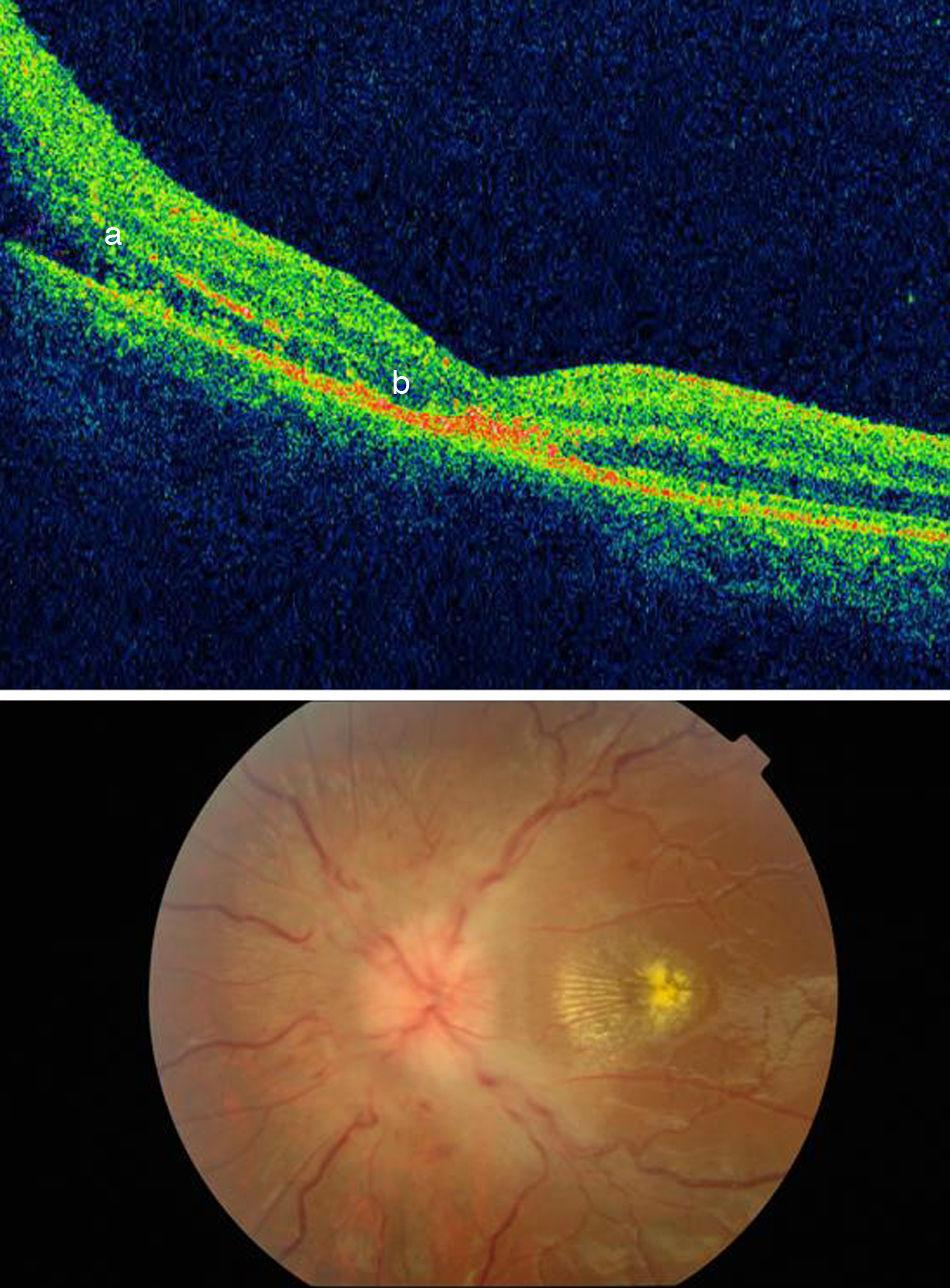 Neurorretinitis y trombosis venosa intracraneal en el síndrome ...