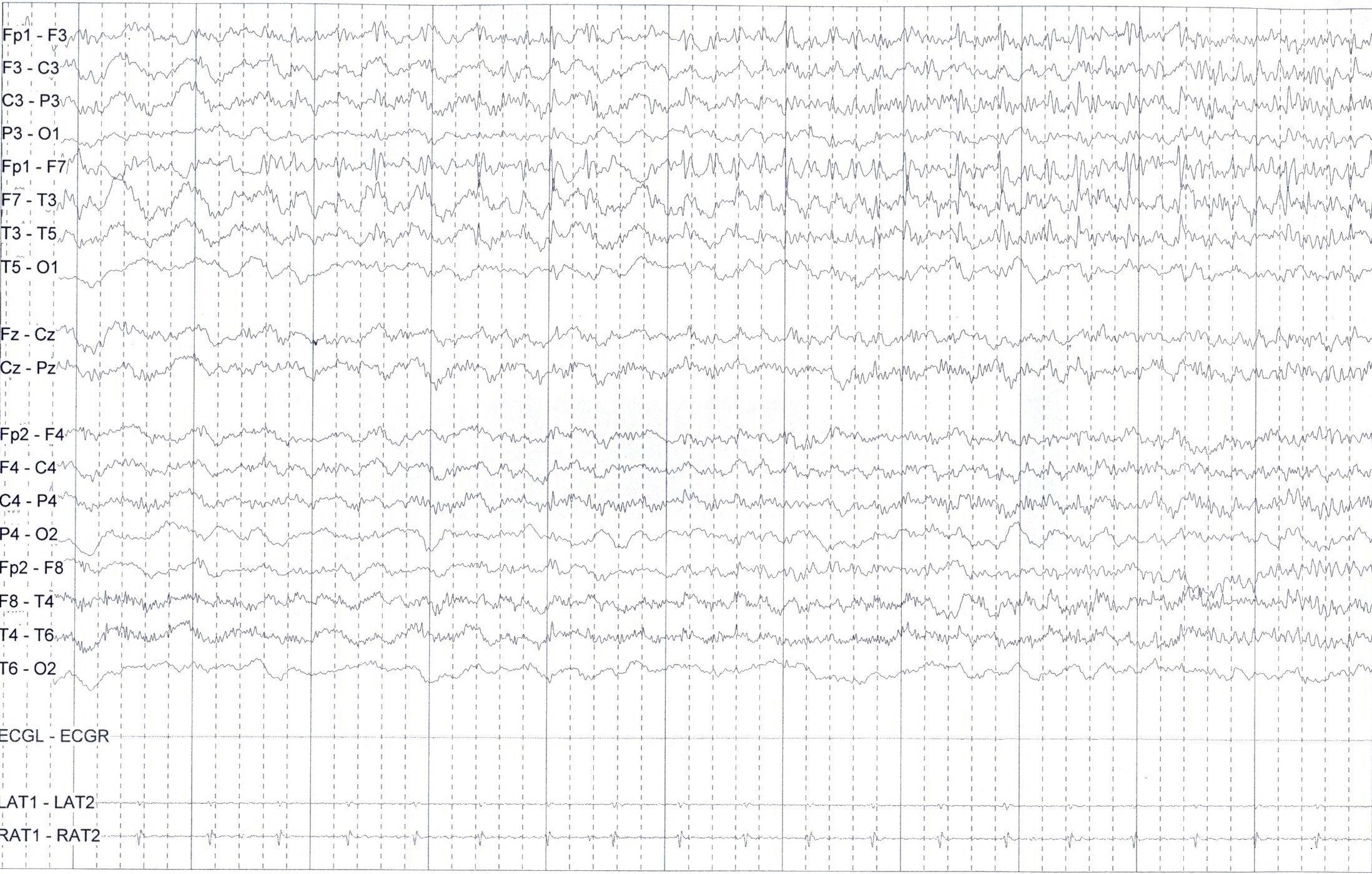 Displasia cortical focal en paciente de 3 años con epilepsia parcial ...