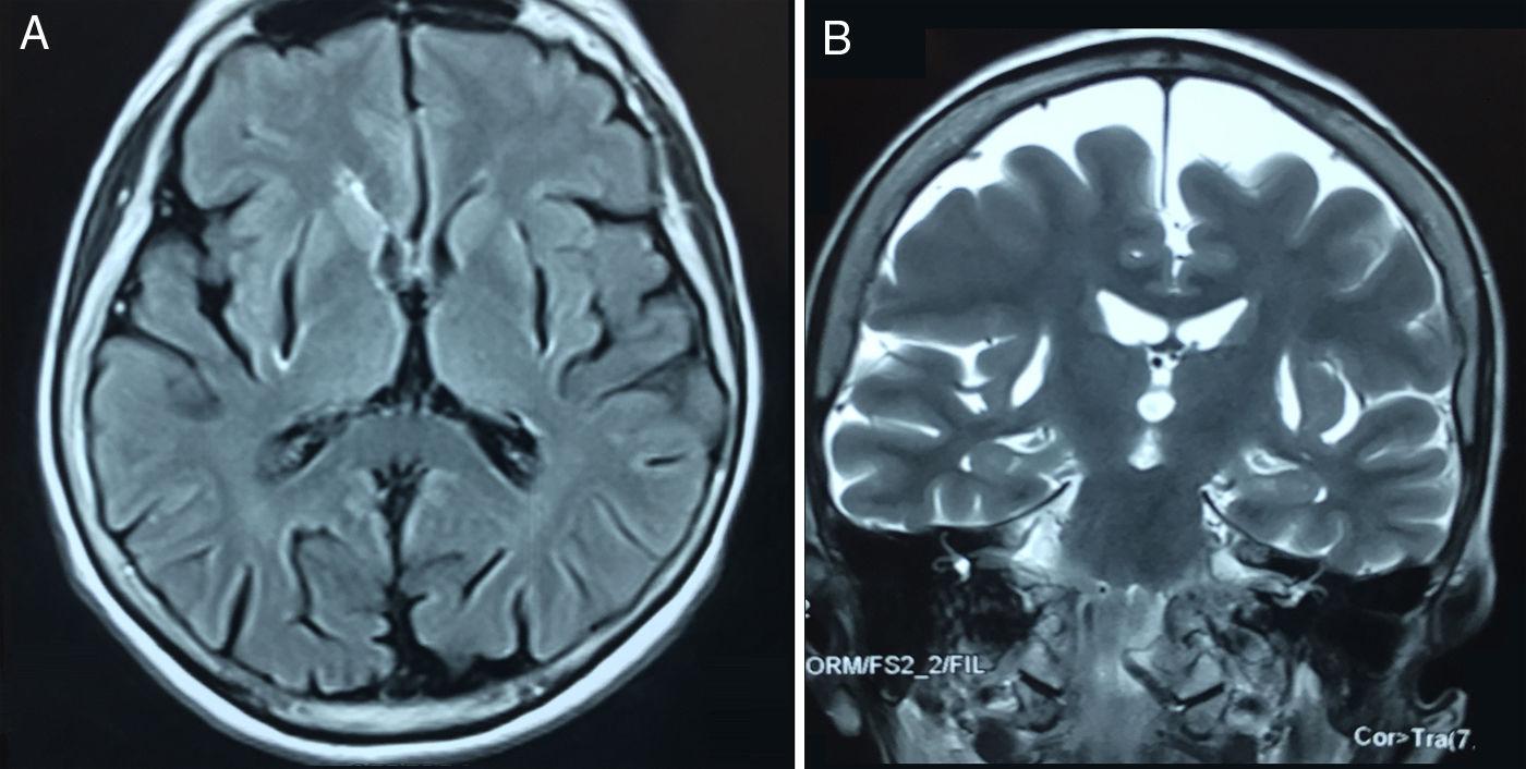 Paciente con parkinsonismo y un antecedente de intoxicación por metanol ...