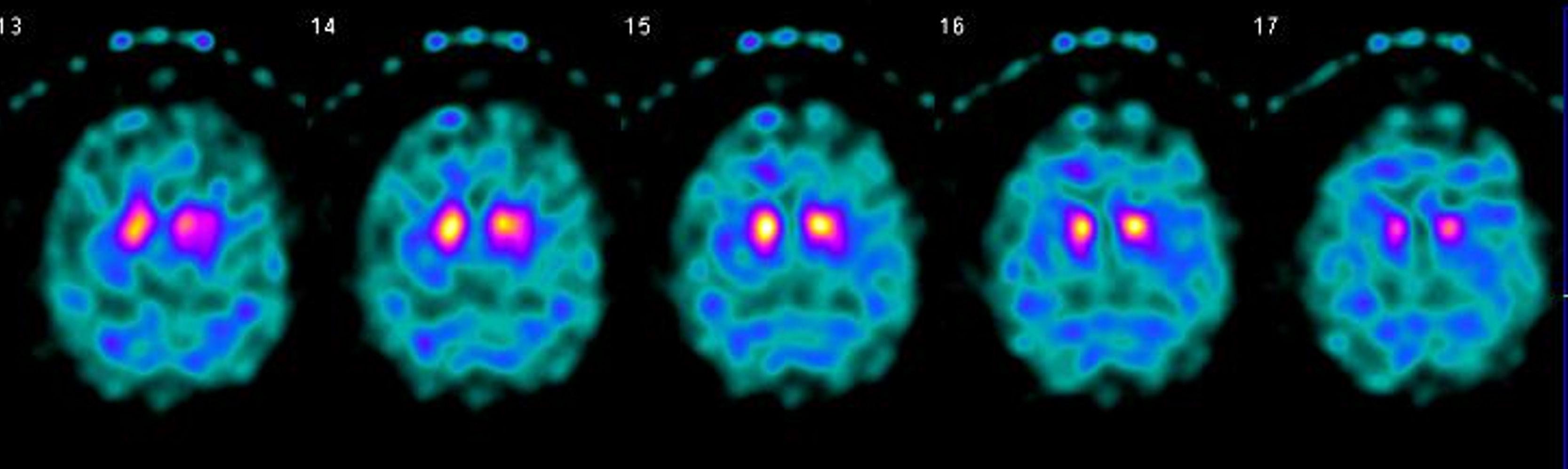 Ataxia cerebelosa progresiva con anticuerpos anti-Ma2 falsamente ...