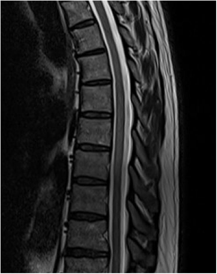 Mielitis transversa aguda asociada a infección por SARS-CoV-2 | Neurología