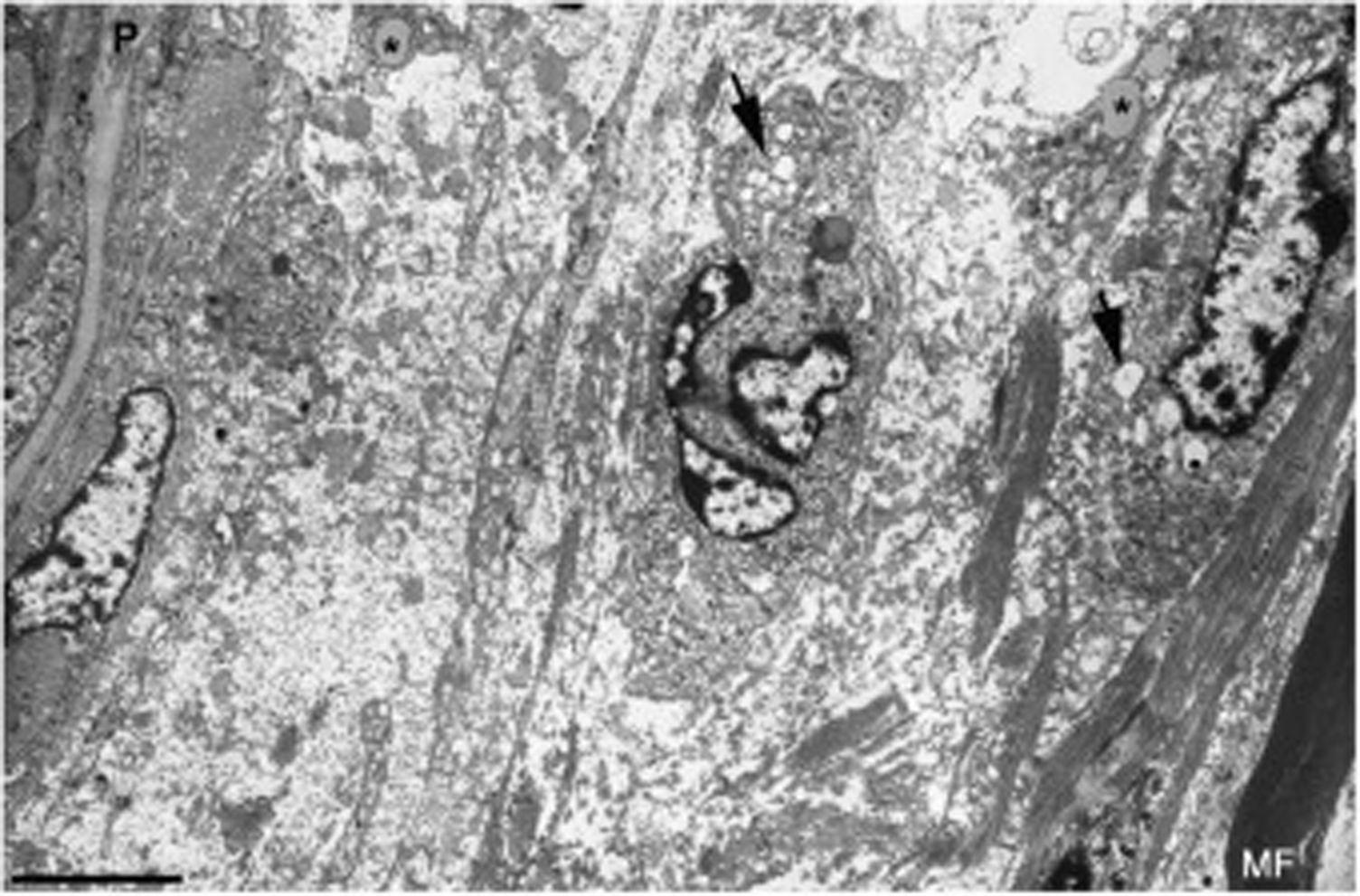 Patología axonal en la fase precoz del síndrome de Guillain-Barré ...