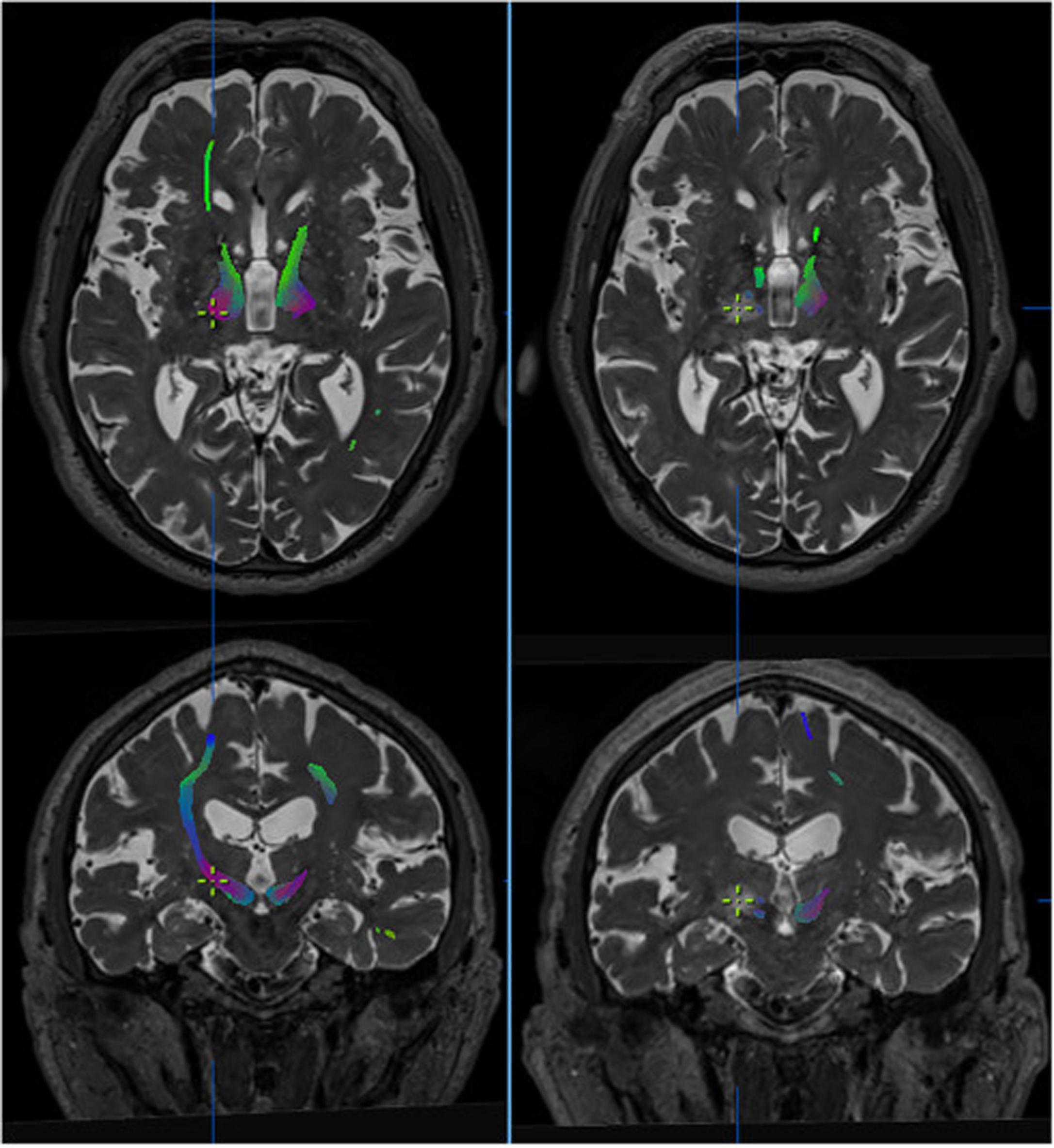 El papel de la tractografía en la localización del núcleo ventralis ...