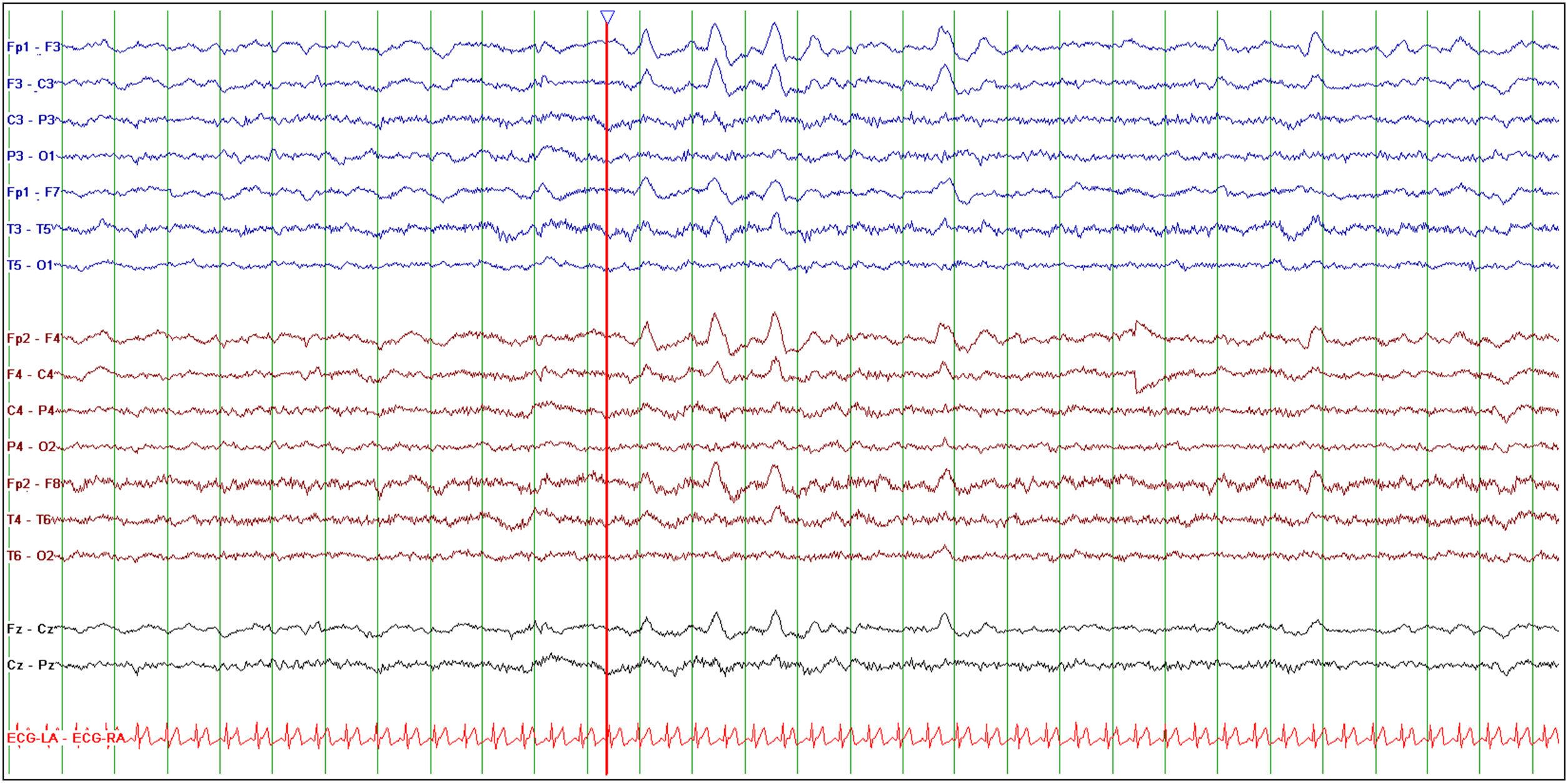 Encefalitis anti-NMDA-R post-COVID-19: descripción de un caso y ...