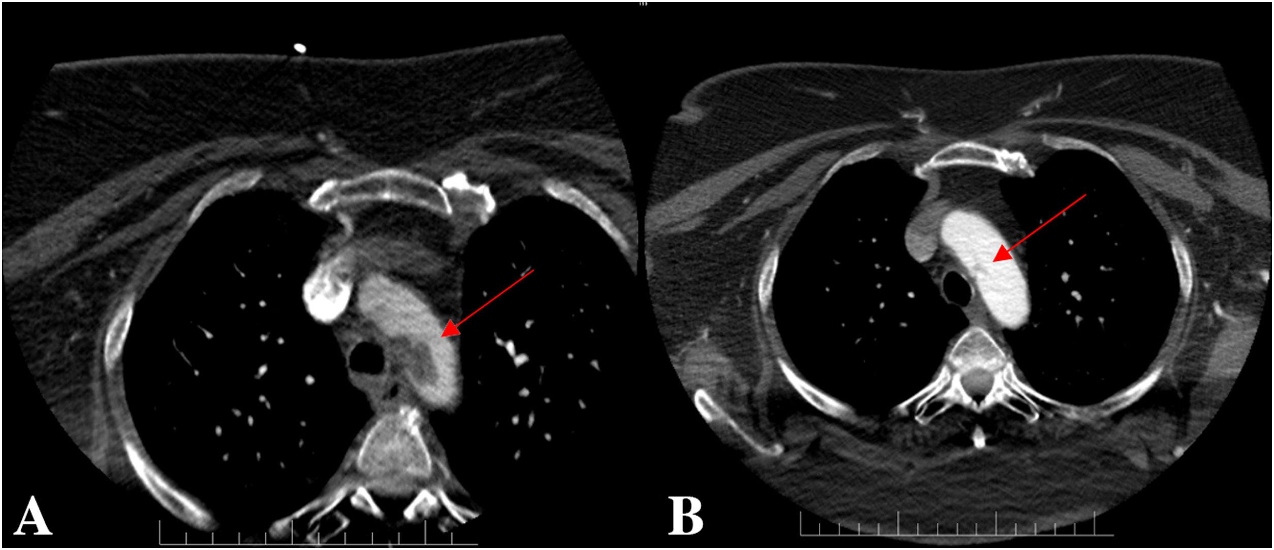 Direct carotid puncture for the endovascular treatment of acute ...
