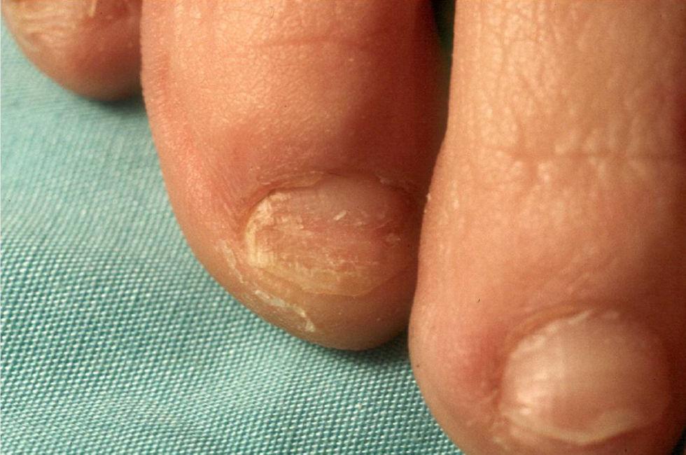 Micosis más frecuentes en inmunodeprimidos | Piel. Formación continuada ...