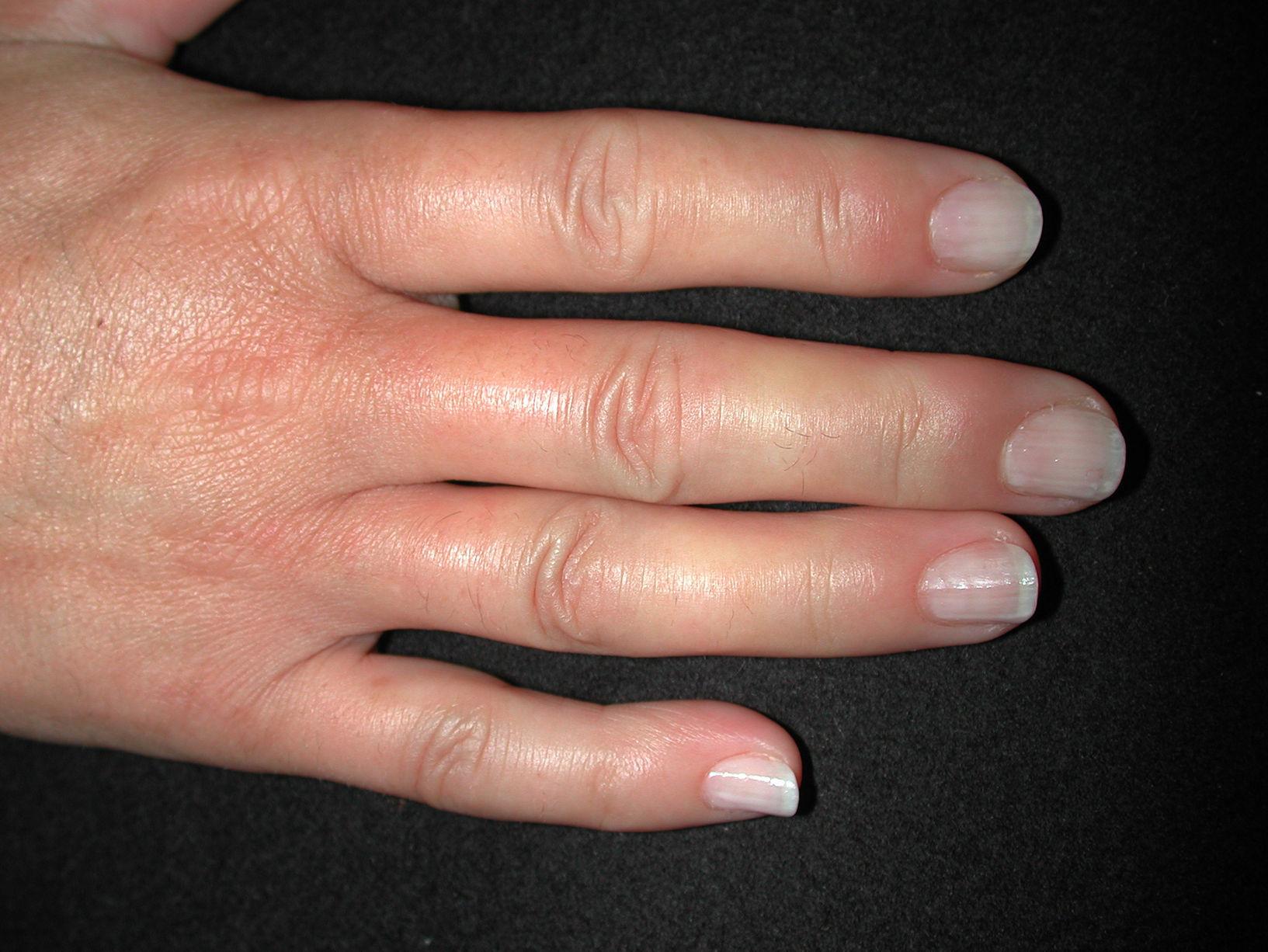 Esclerodermia (esclerosis sistémica) | Piel. Formación continuada en ...