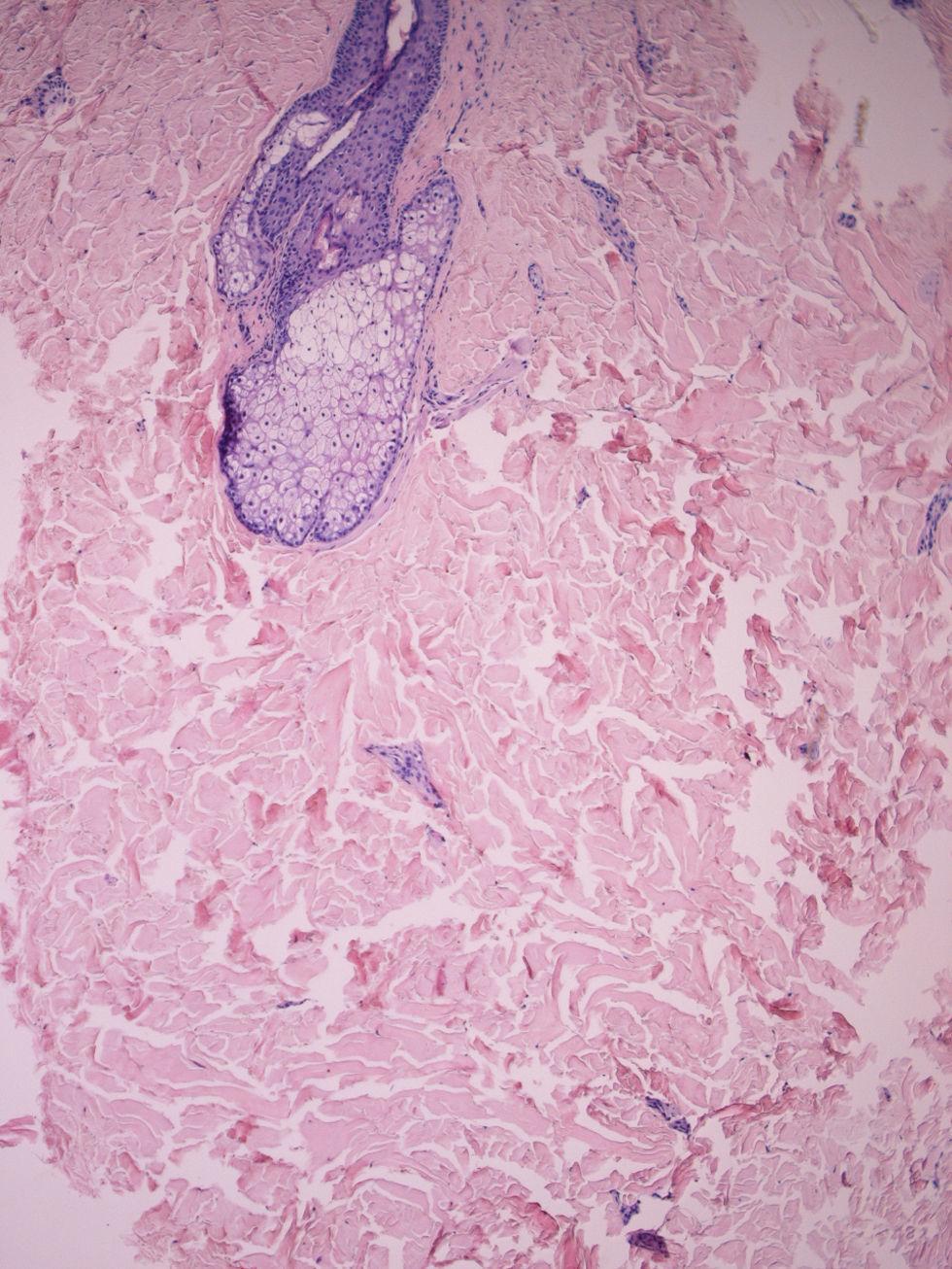Esclerodermia (esclerosis sistémica) | Piel. Formación continuada en ...