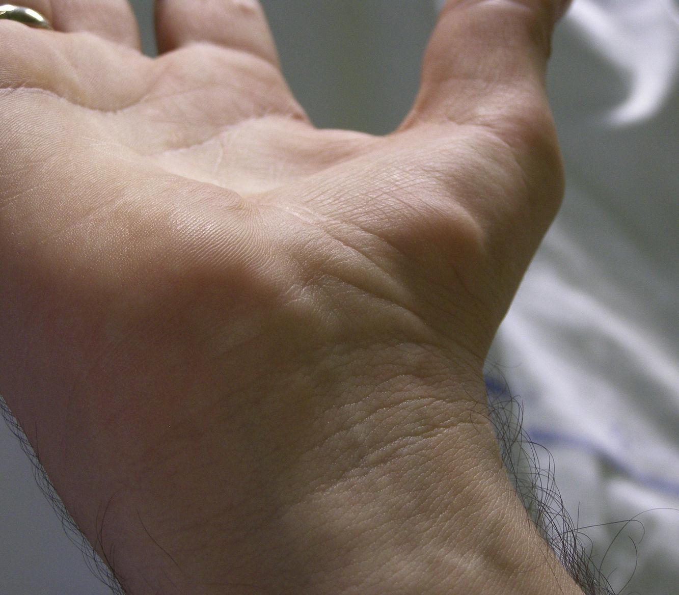 Neurofibromatosis de tipo 2: hallazgo de una nueva mutación en el gen ...