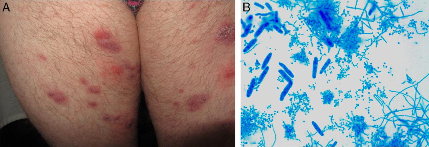 Dermatofitosis profunda en paciente inmunocompetente: a propósito de 2 ...