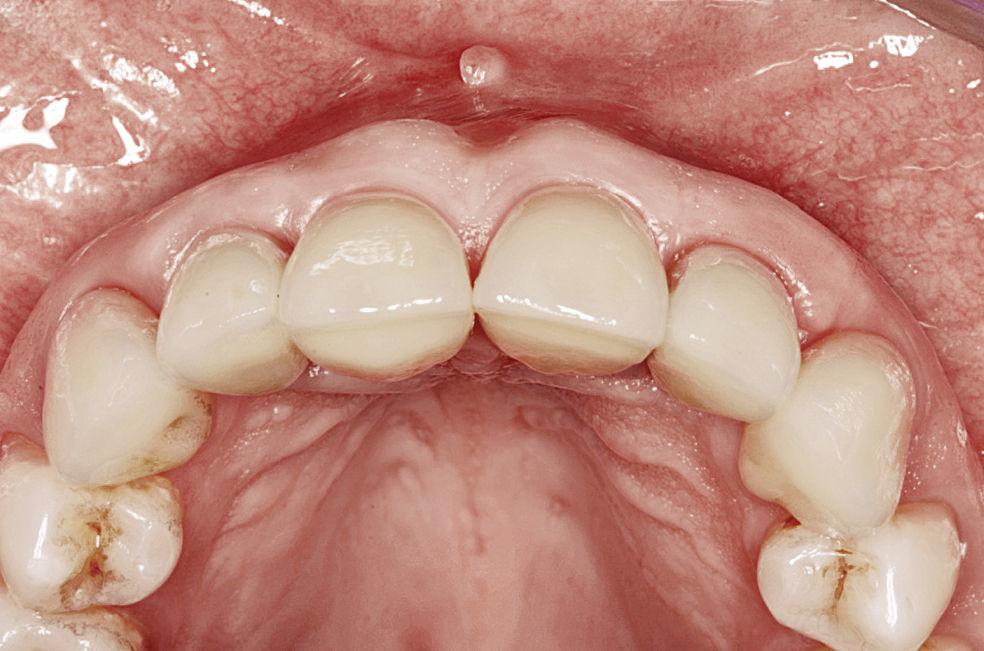 Manejo de tejidos blandos: estética roja y blanca | Quintessence