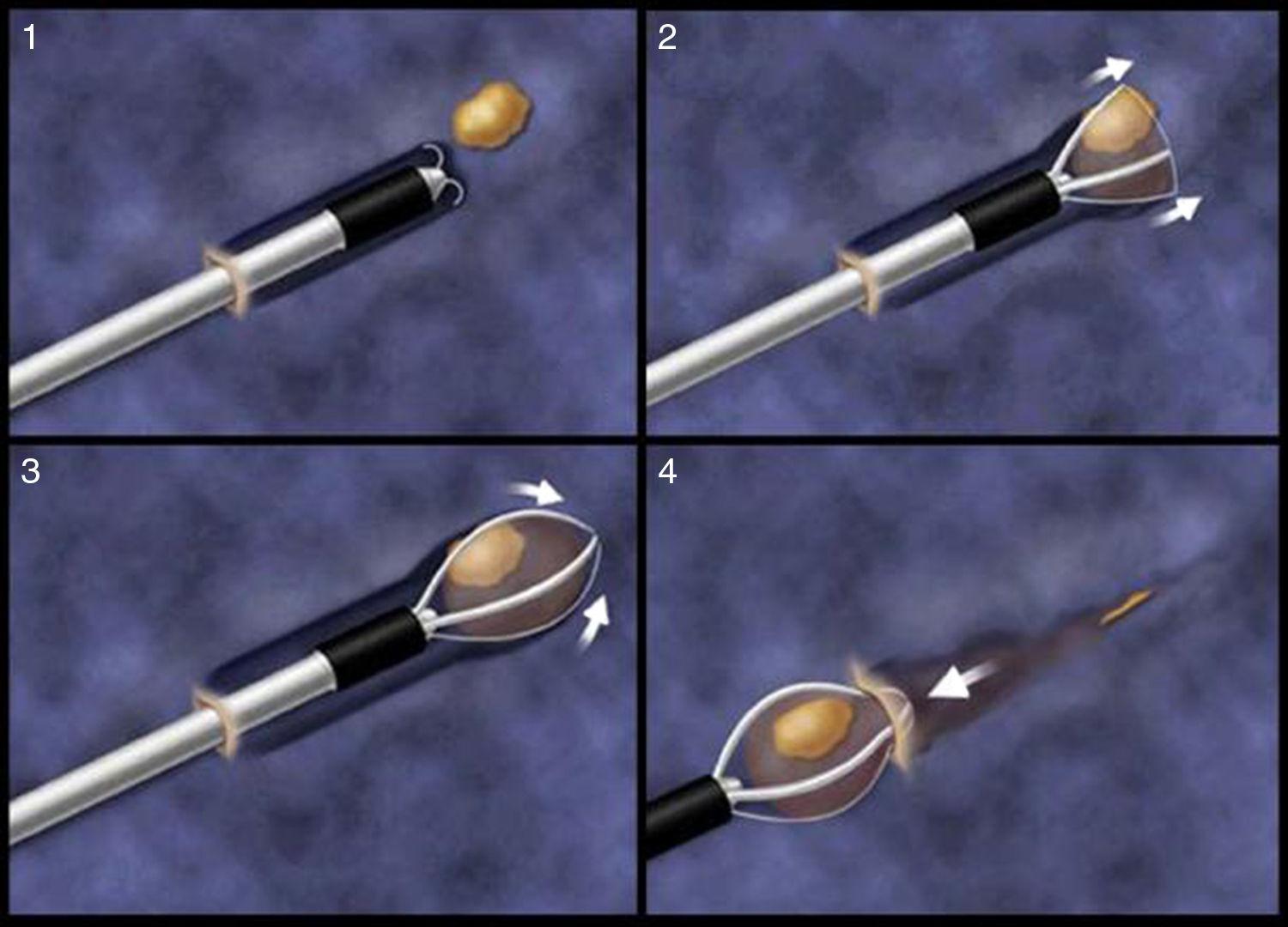 Tratamiento definitivo de las lesiones premalignas de la mama sin ...