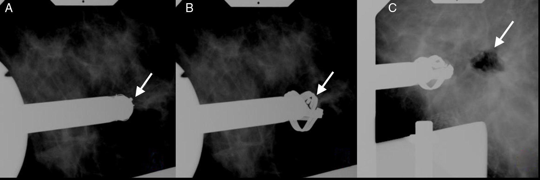 Tratamiento definitivo de las lesiones premalignas de la mama sin ...