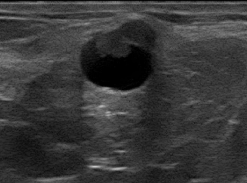 Novedades de la 5.a edición del sistema breast imaging reporting and ...