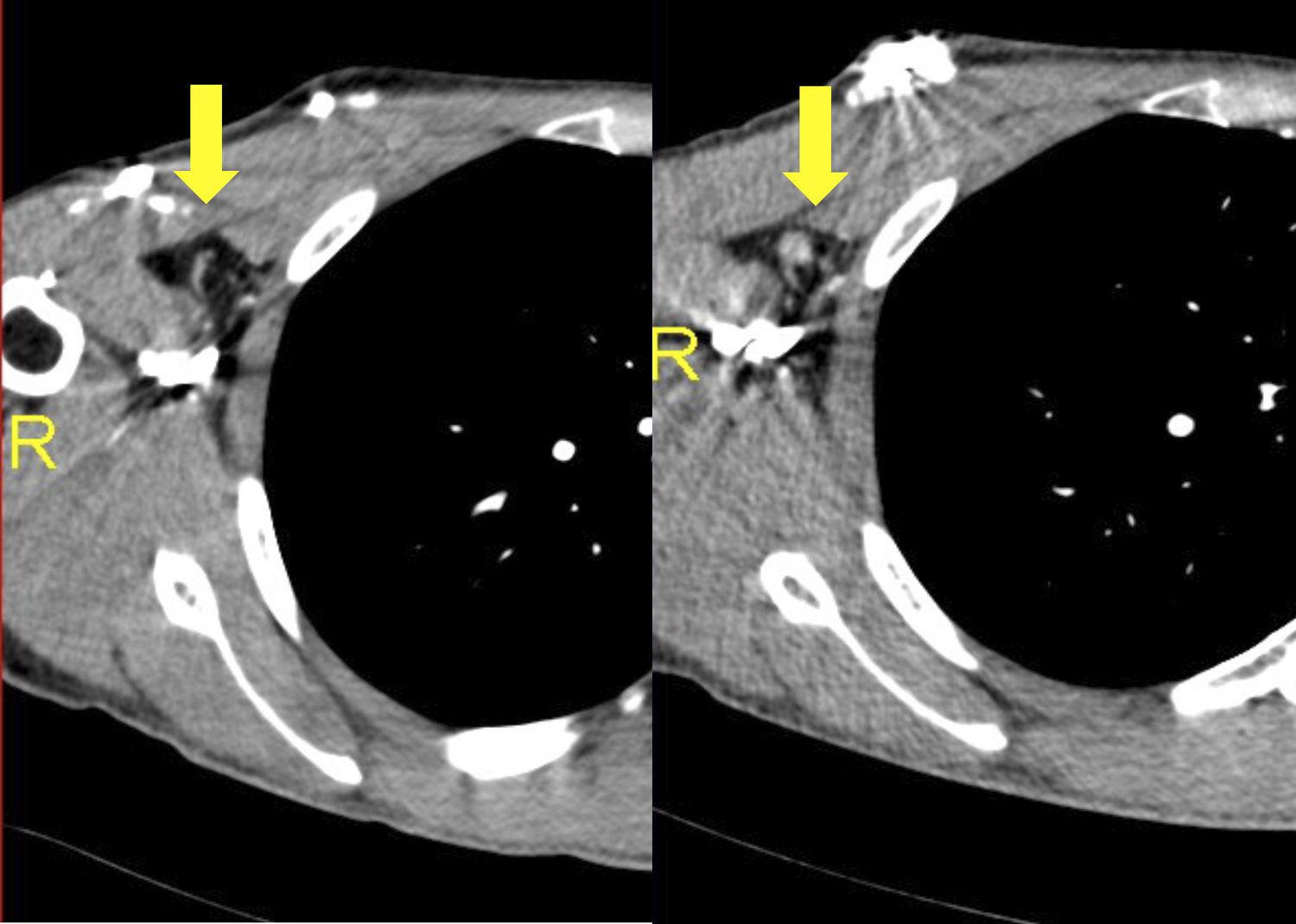 Metástasis ganglionares axilares contalaterales en cáncer de mama ...