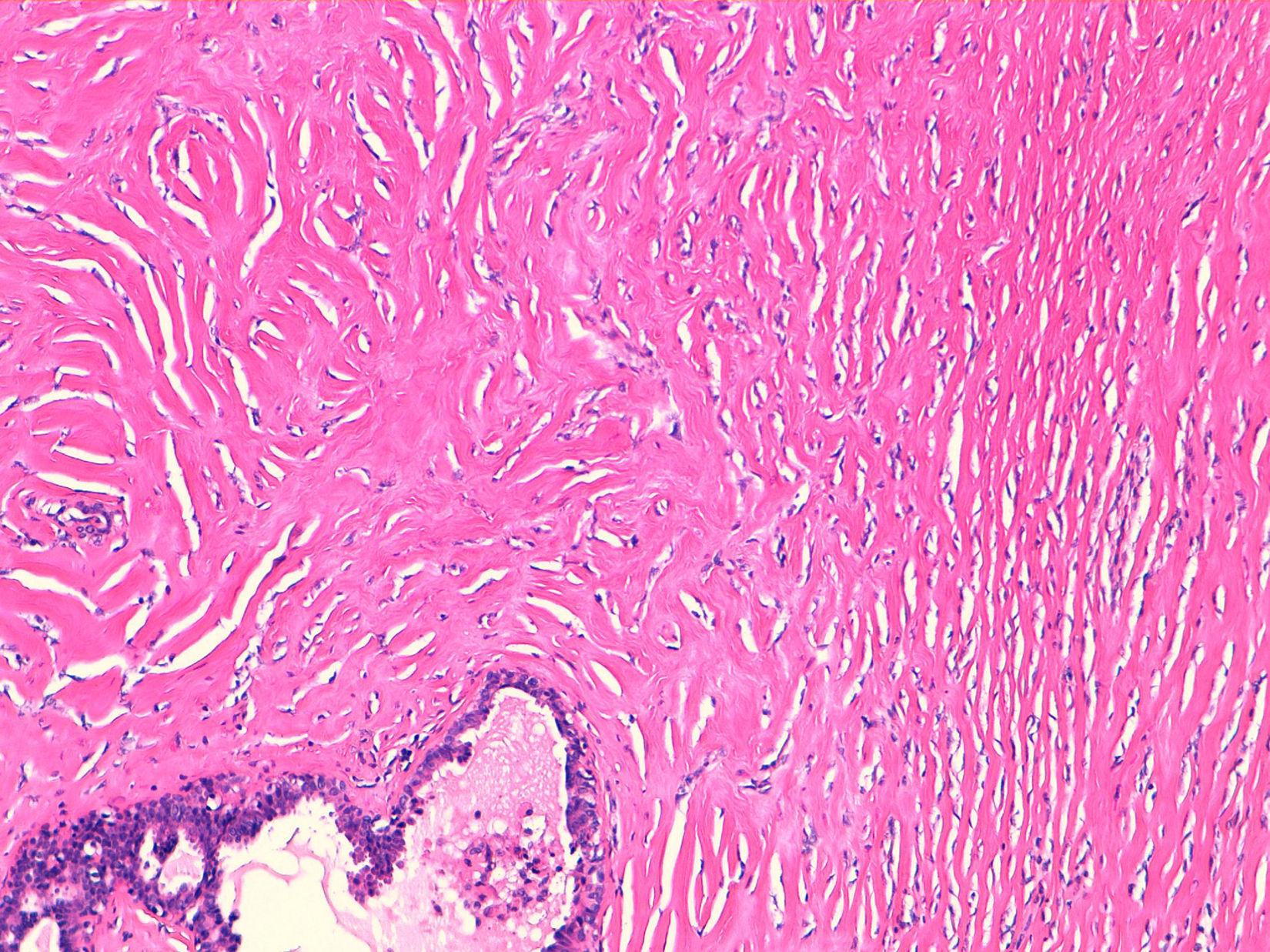Hiperplasia estromal seudoangiomatosa. Una lesión de la mama ...