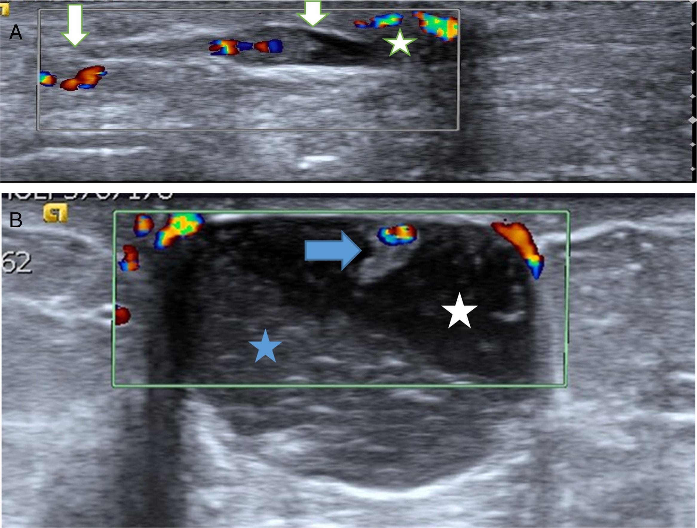 Utilidad de la biopsia asistida con vacío guiada con ecografía en el ...