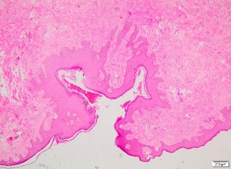 Soft fibroma of the nipple: Clinical and histopathological ...