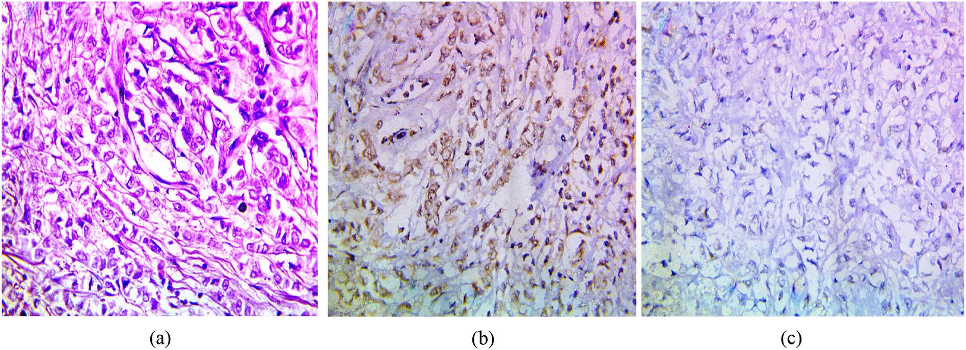 Diagnostic utility of PELP1 and GATA3 in primary and metastatic triple ...