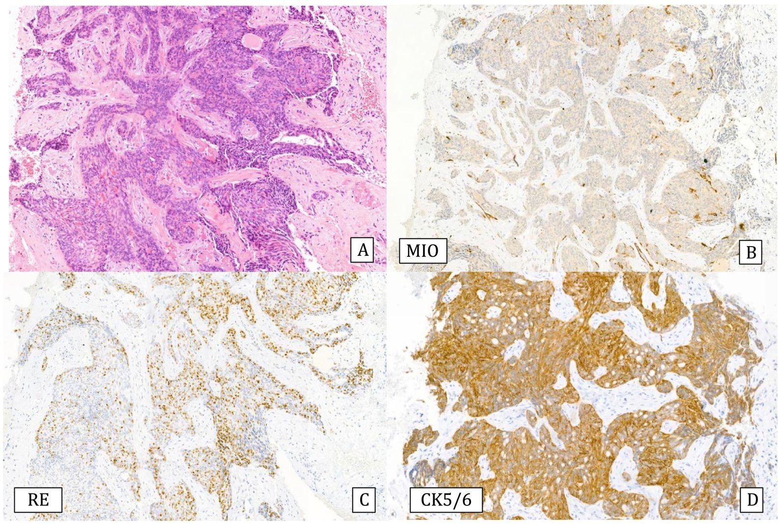 Diagnostic problems in high-risk breast lesions | Revista de Senología ...