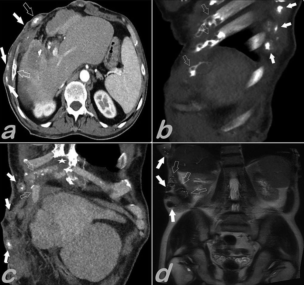 Metastases of Alveolar Echinococcosis to the Skin, Pleura, Ribs, and ...