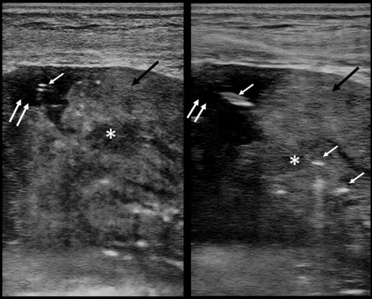 Biopsia de lesiones intrapulmonares en pulmones con atelectasia y ...