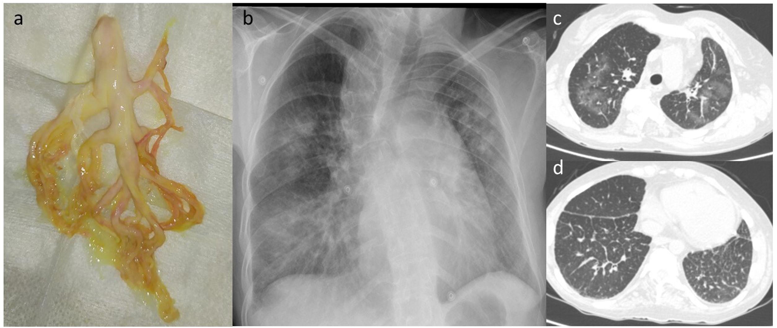Bronquitis plástica y síndrome de Noonan | Archivos de Bronconeumología