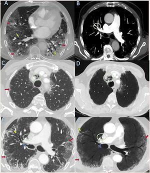 Spontaneous Pneumomediastinum and Macklin Effect in COVID-19 Patients ...
