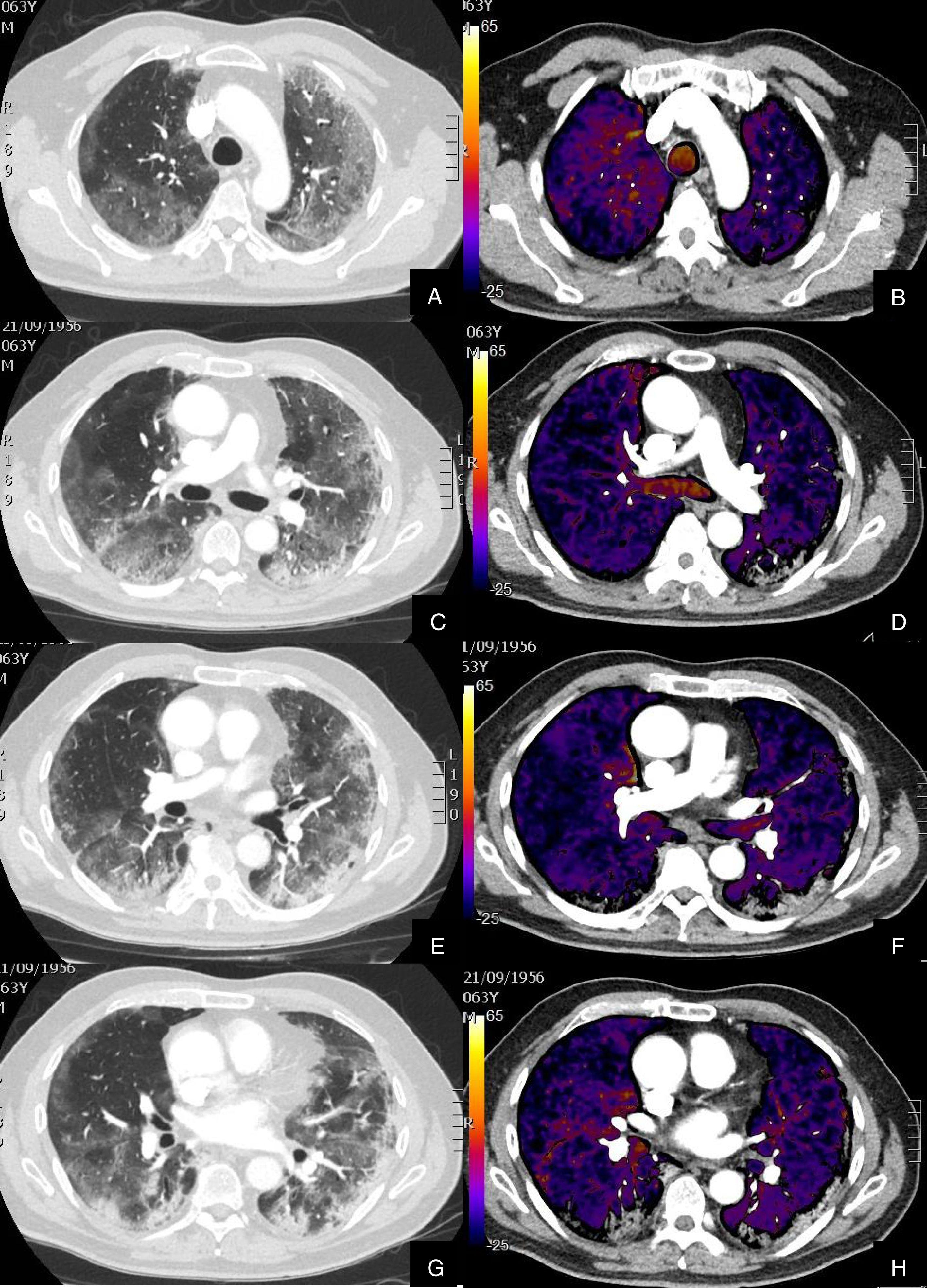 Pulmones azules en pacientes COVID-19: un paso más allá del diagnóstico ...