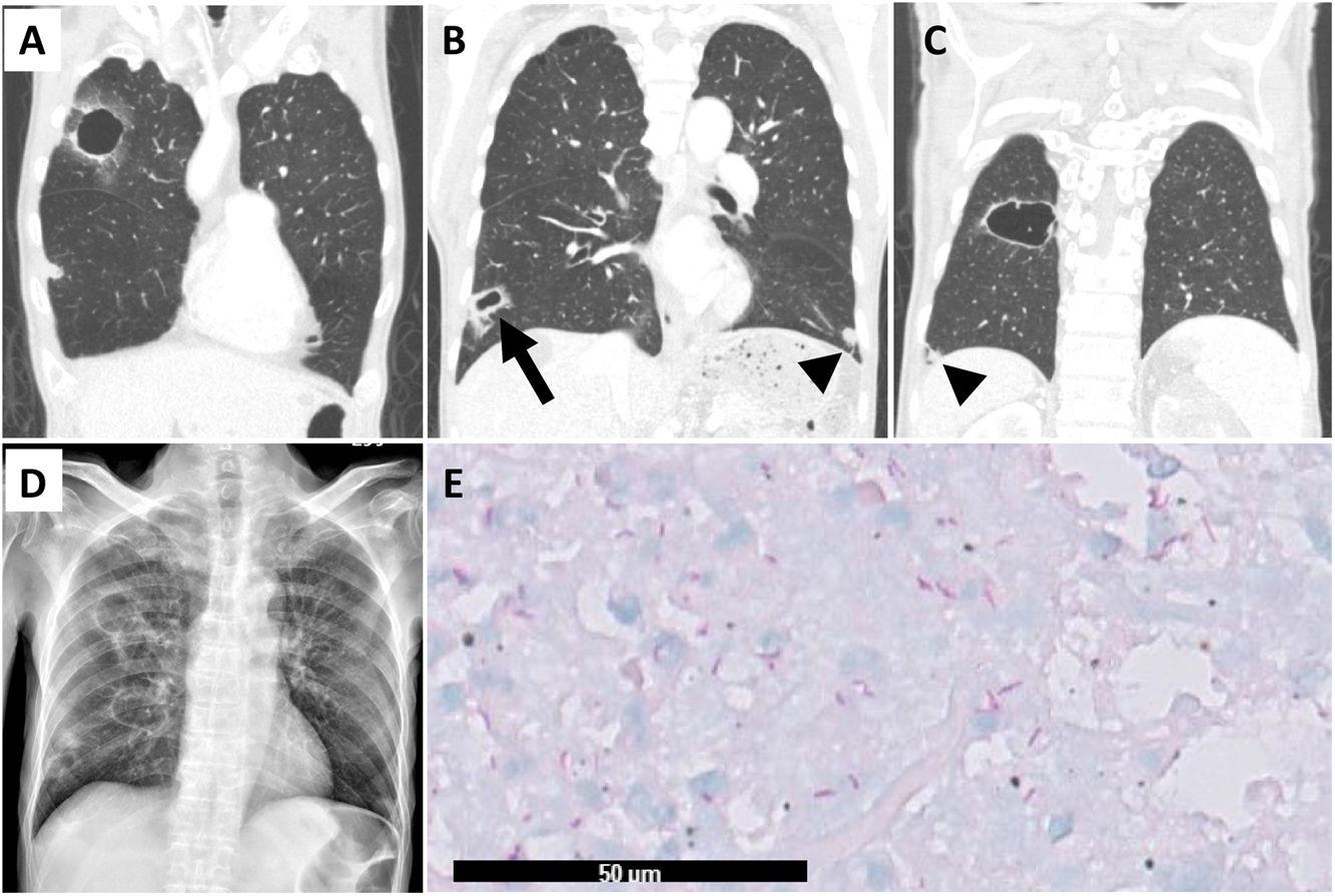 Cavitary Mycobacterium avium Complex Lung Disease Developed After ...
