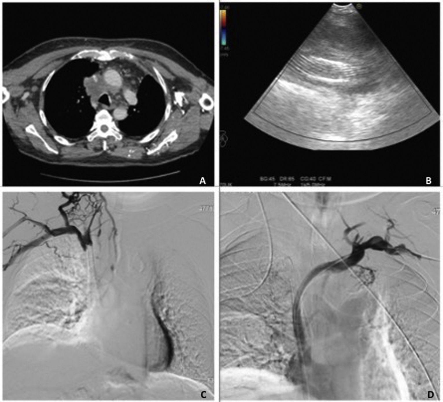 [Translated article] Diagnosing Superior Vena Cava Stent Thrombosis by ...
