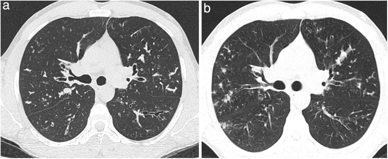 Association Between Evolution of Mucus Plugging, Parenchymal ...