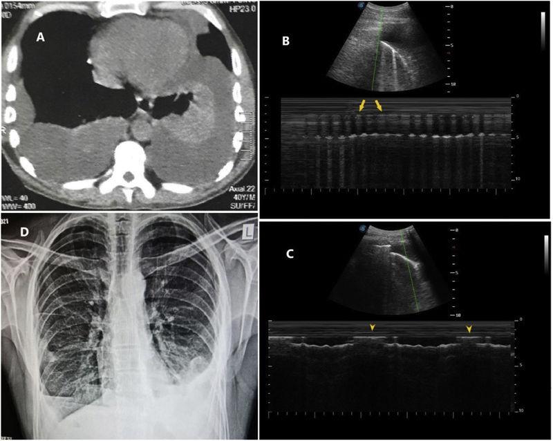 A Hydropneumothorax Captured by M-mode Ultrasonography | Archivos de ...