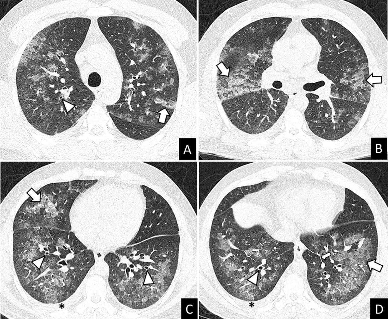 Acute Eosinophilic Pneumonia Following mRNA COVID-19 Vaccination: A ...