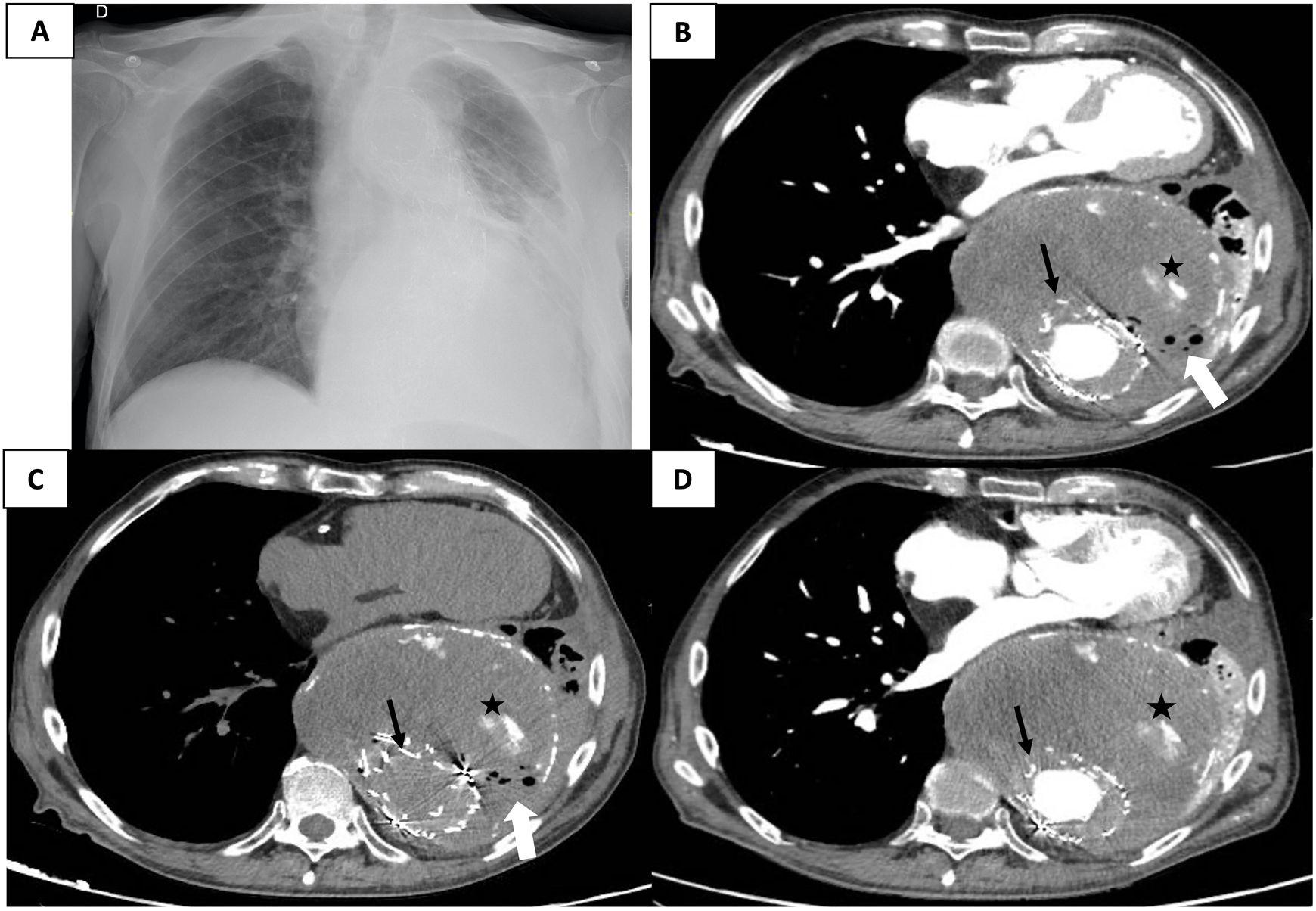 Aortobronchopulmonary Fistula—An Unusual Cause of Hemoptysis | Archivos ...