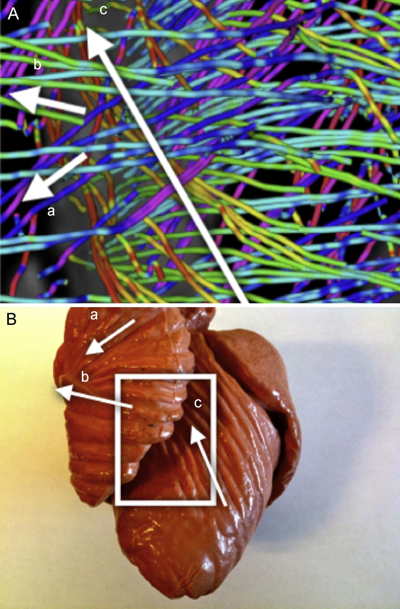 Estudio tractográfico de la anatomía helicoidal del miocardio ...